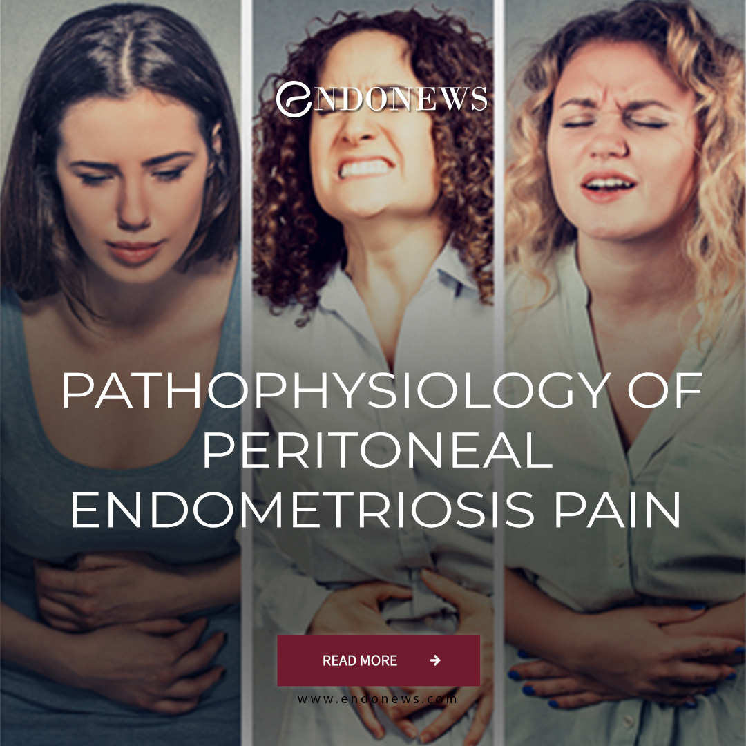 Pathophysiology of peritoneal endometriosis pain. | EndoNews