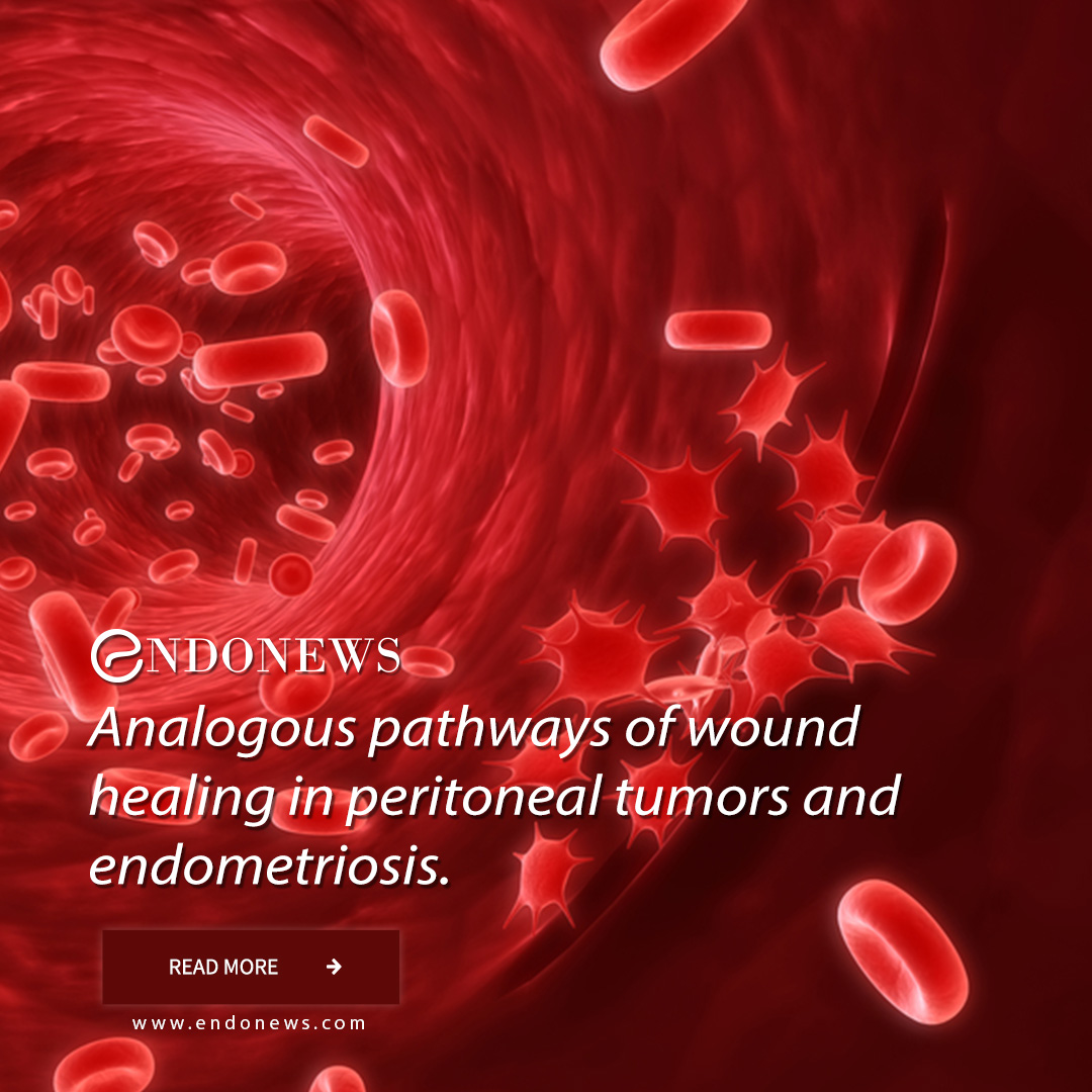 Analogous pathways of peritoneal tumor wound healing and endometriosis ...