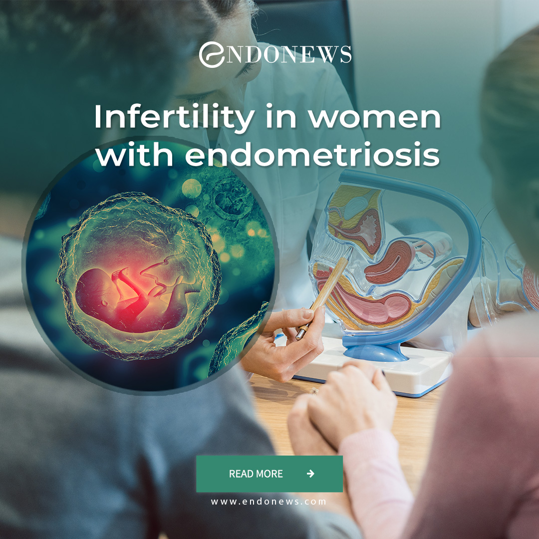 Infertility in women with endometriosis | EndoNews