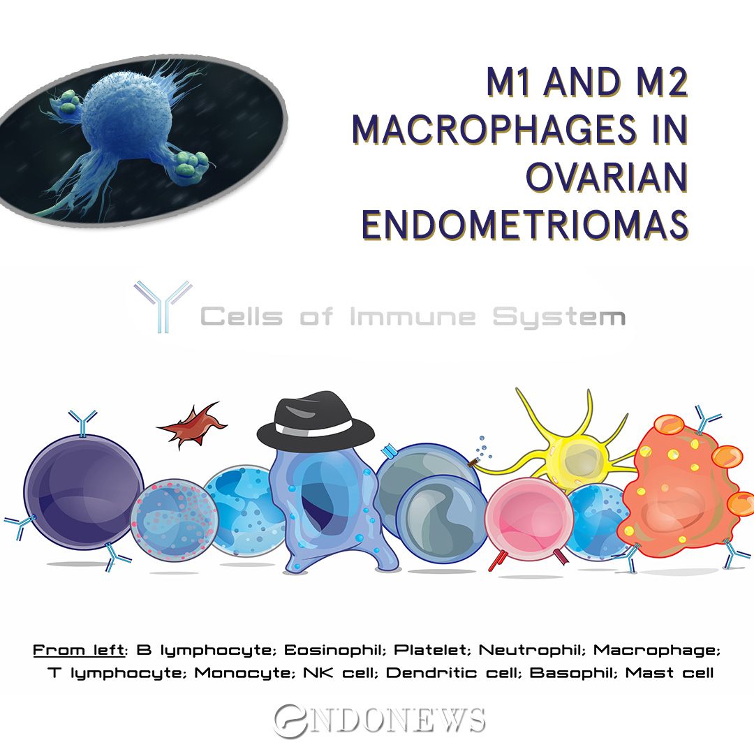 M1 and M2 macrophages in ovarian endometriomas | EndoNews