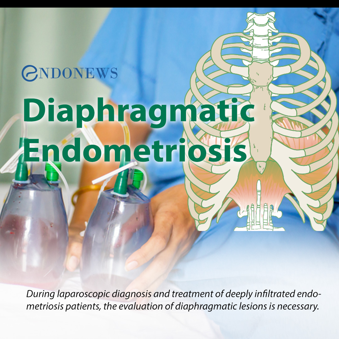 Diaphragmatic Endometriosis Endonews