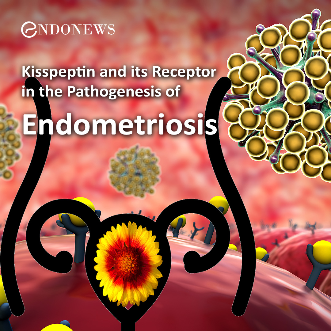 Kisspeptin and its Receptor in the Pathogenesis of Endometriosis | EndoNews