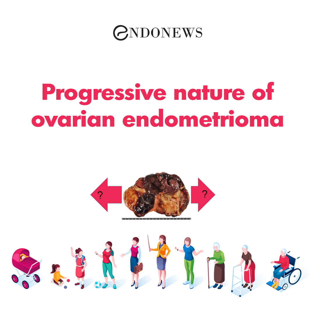 Progressive nature of ovarian endometrioma | EndoNews