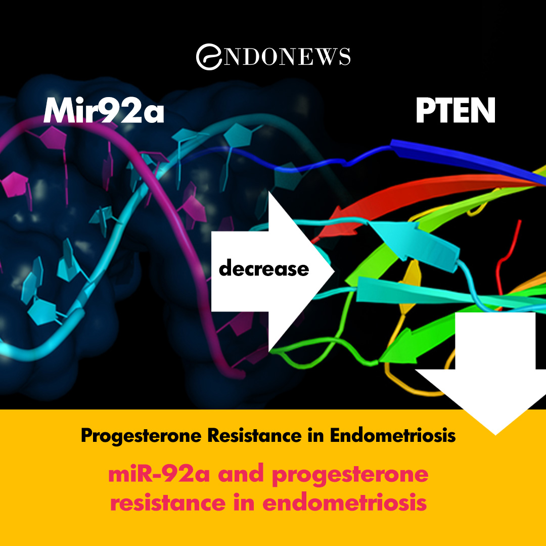 miR-92a and progesterone resistance in endometriosis | EndoNews