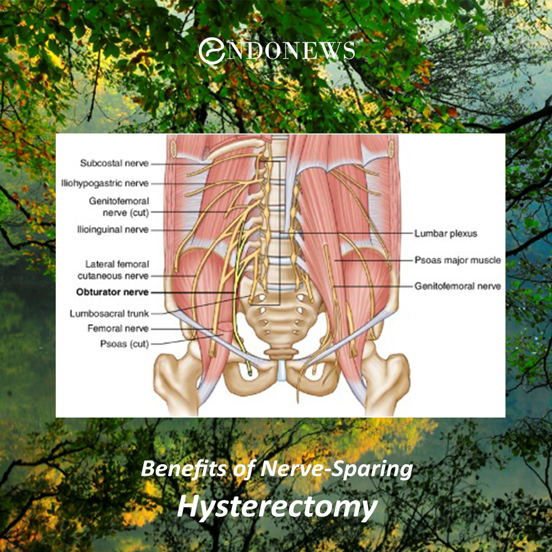 Benefits Of Nerve Sparing Hysterectomy Endonews