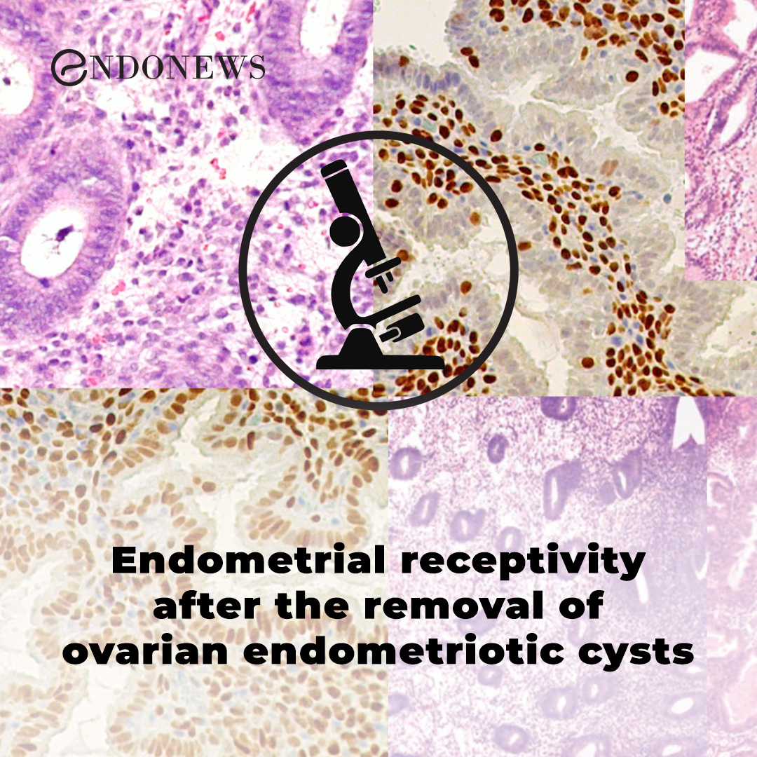 Endometrial Receptivity After The Removal Of Ovarian Endometriotic