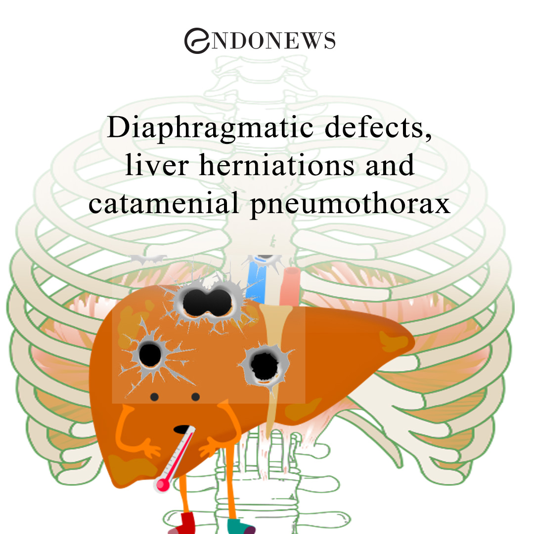 Diaphragmatic Defects Liver Herniations And Catamenial Pneumothorax Diaphragmatic Defects Liver Herniations And Catamenial Pneumothorax