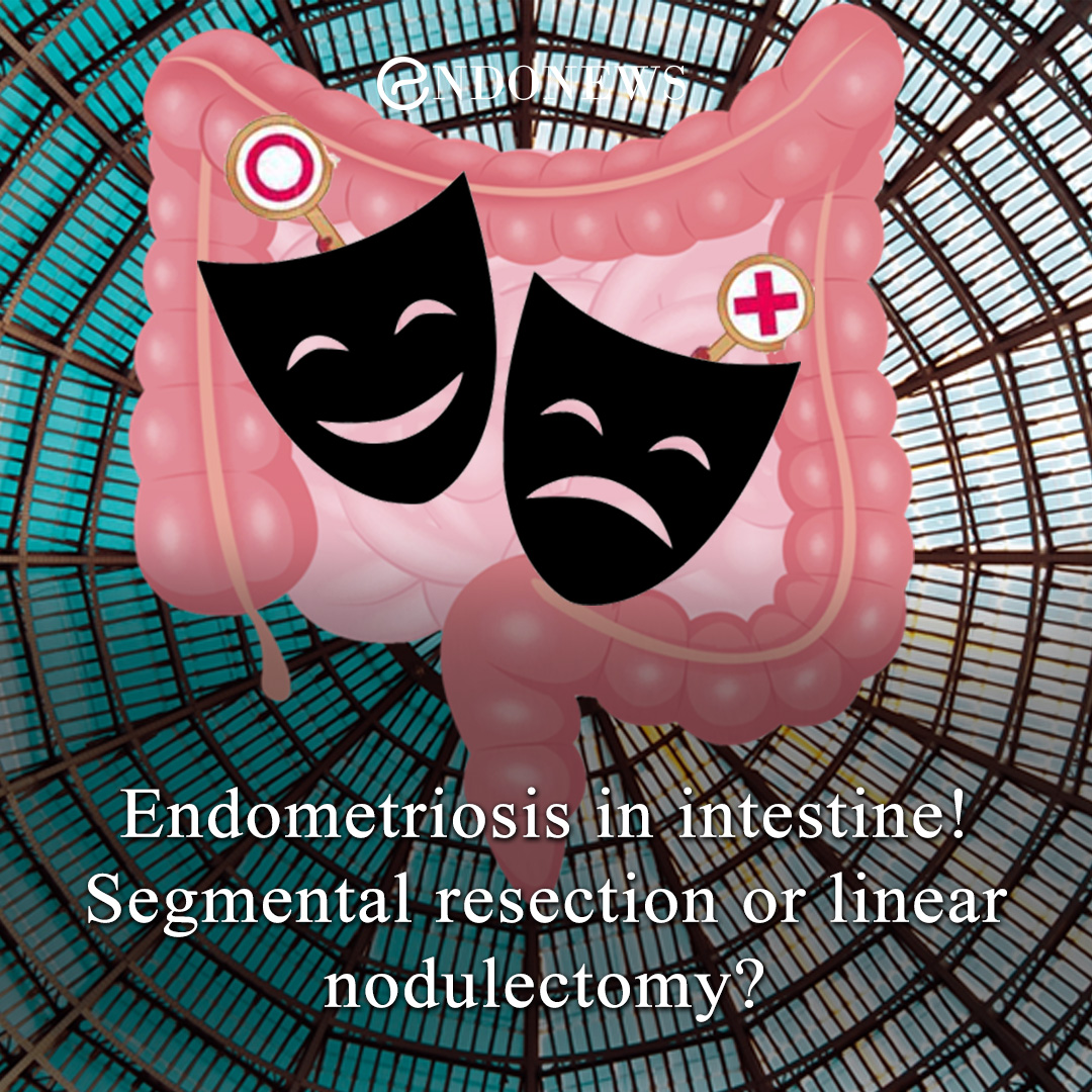 Endometriosis in intestine! Segmental resection or linear nodulectomy ...