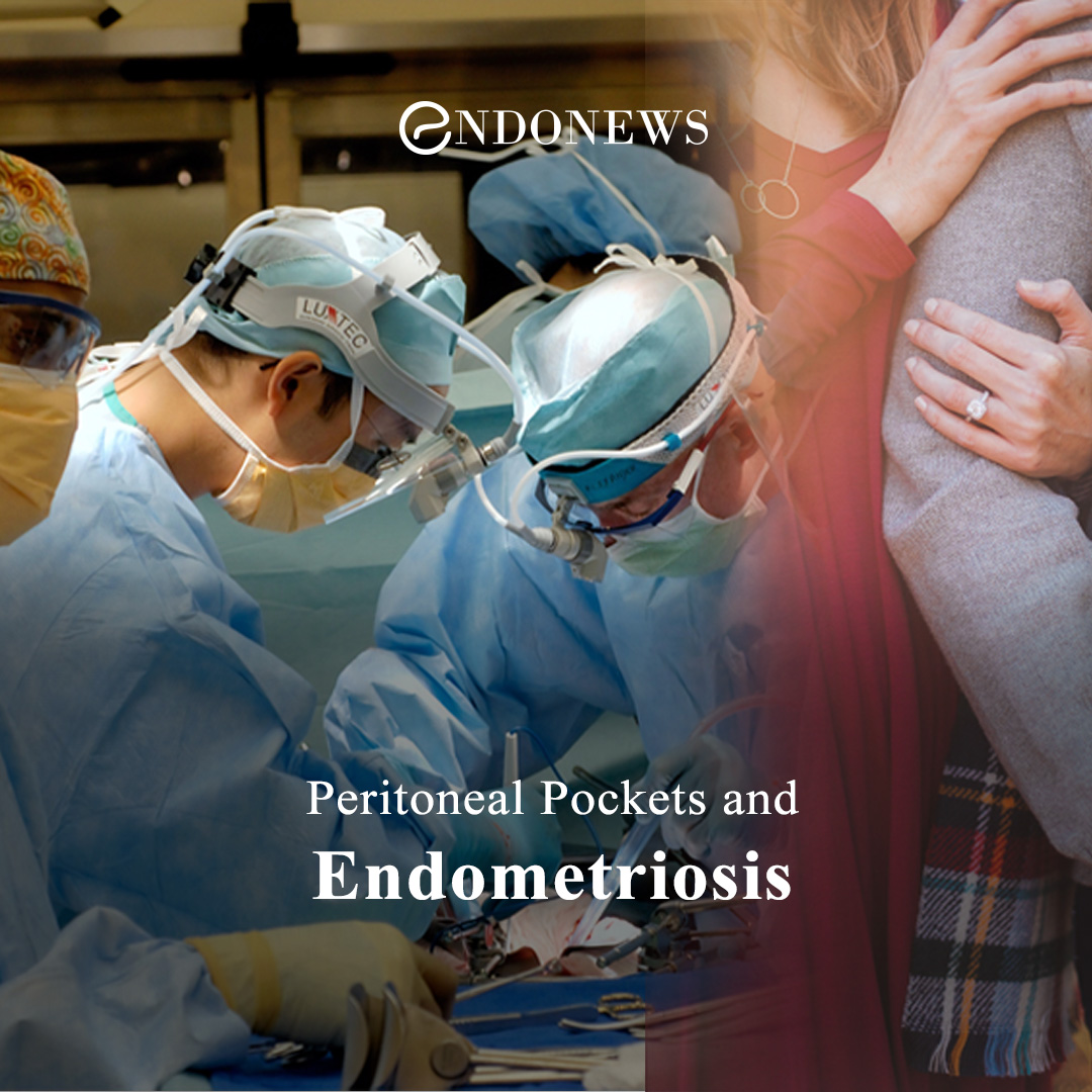 Peritoneal Pockets and Endometriosis | EndoNews