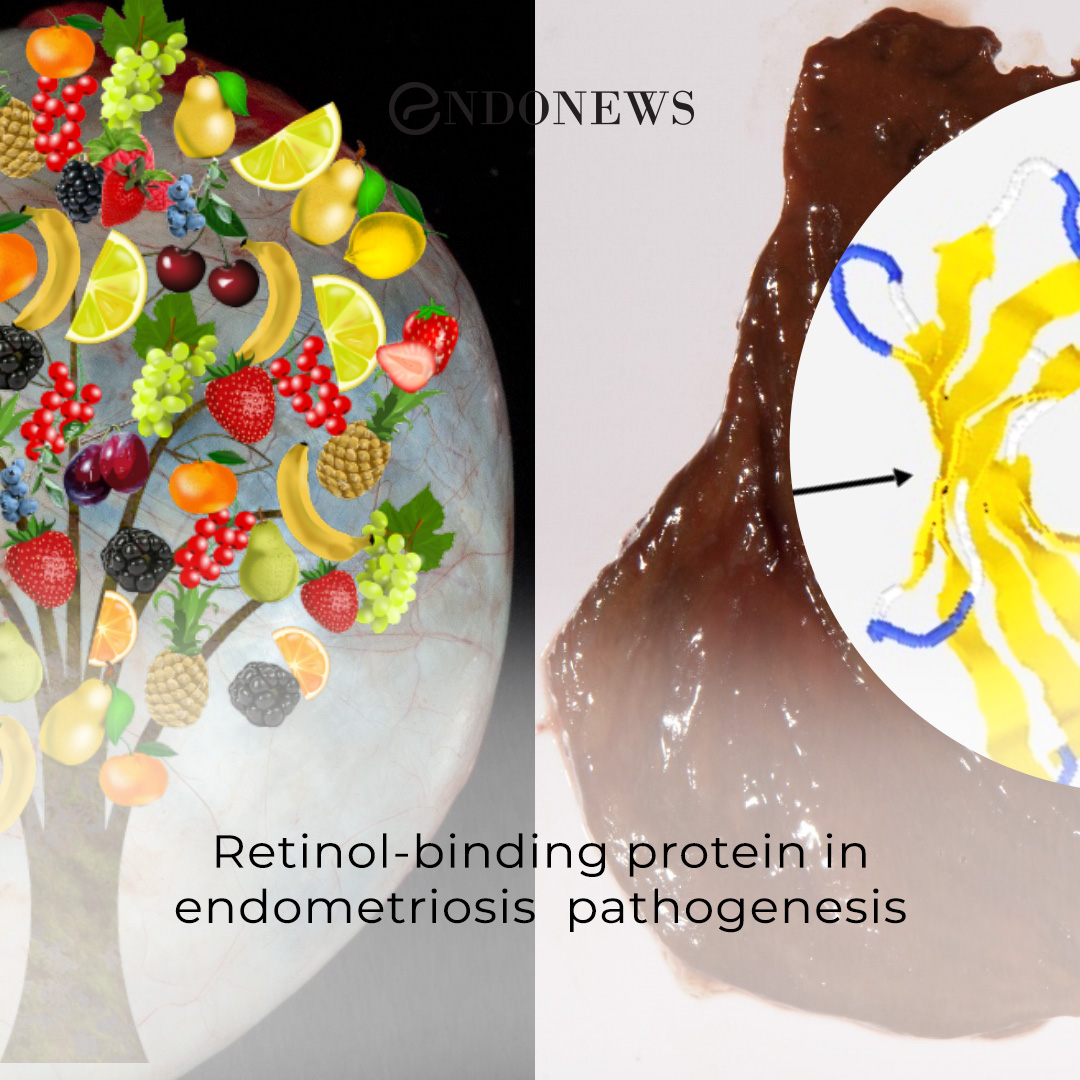 Retinol-binding protein in endometriosis pathogenesis | EndoNews