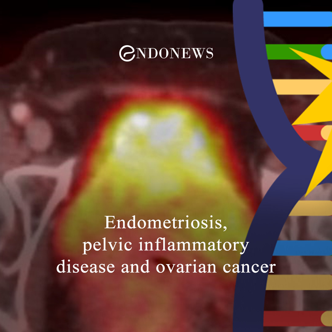 Endometriosis Pelvic Inflammatory Disease And Ovarian Cancer Endonews