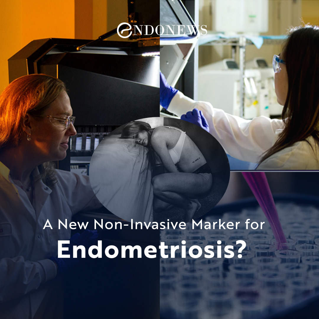 A New Non-Invasive Marker for Endometriosis? | EndoNews