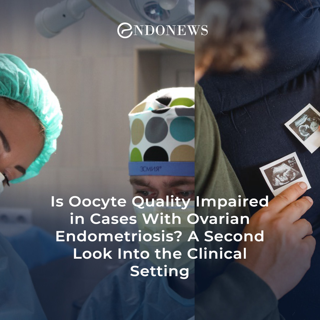 The Oocyte Quality in Ovarian Endometriosis | EndoNews