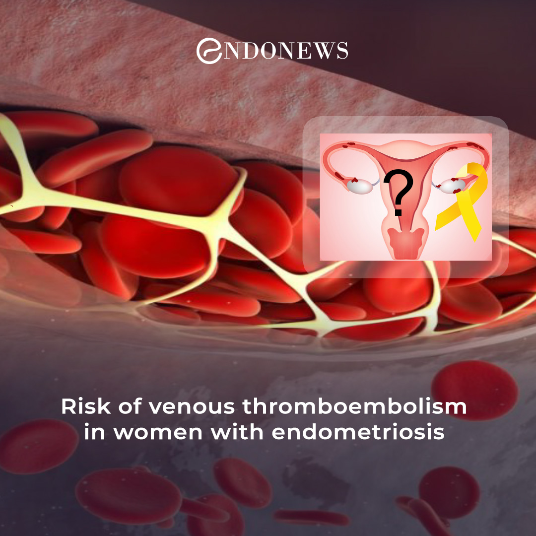 The Association Between Severe Endometriosis And Venous Thromboembolism