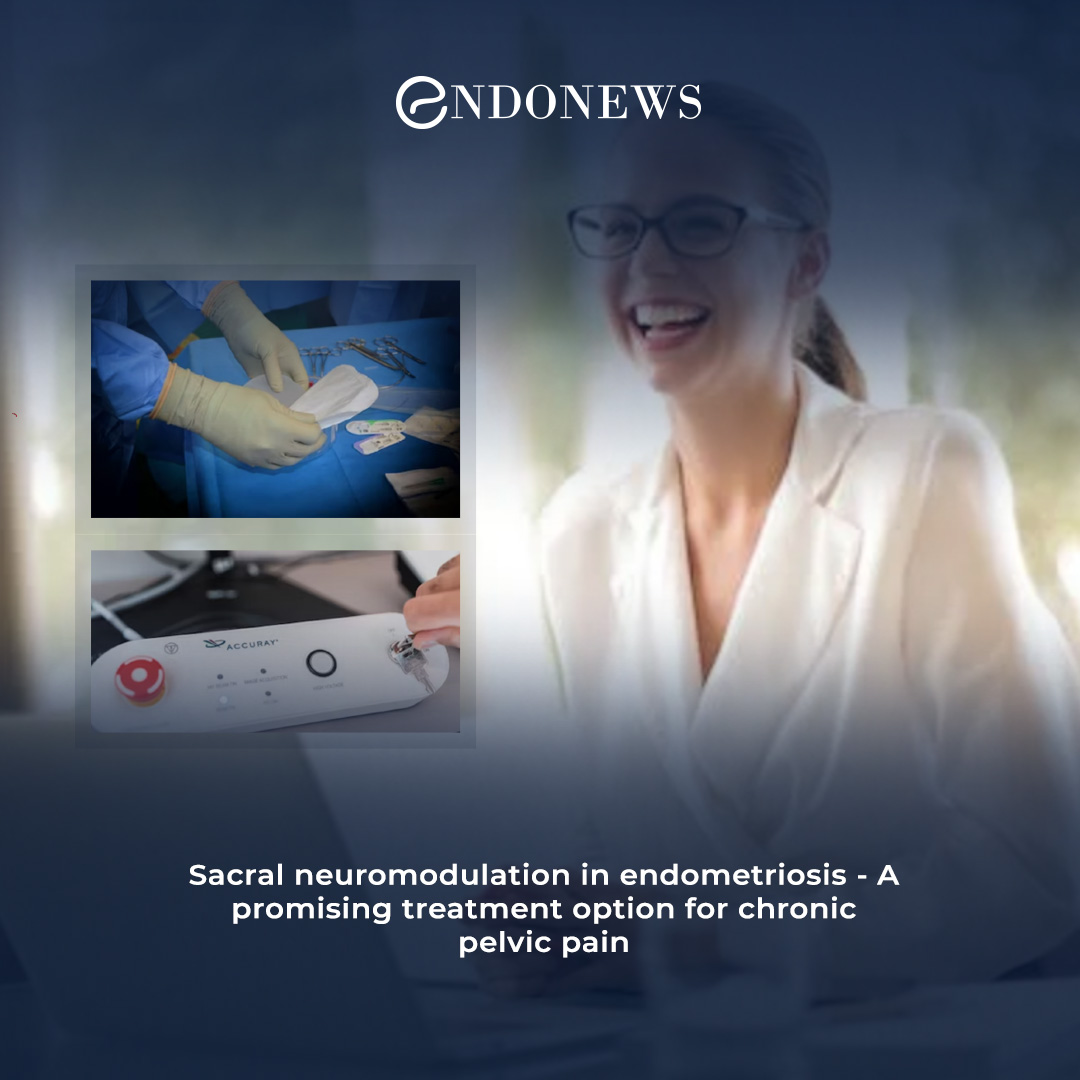 Sacral neuromodulation for endometriosis-related chronic pelvic pain | EndoNews