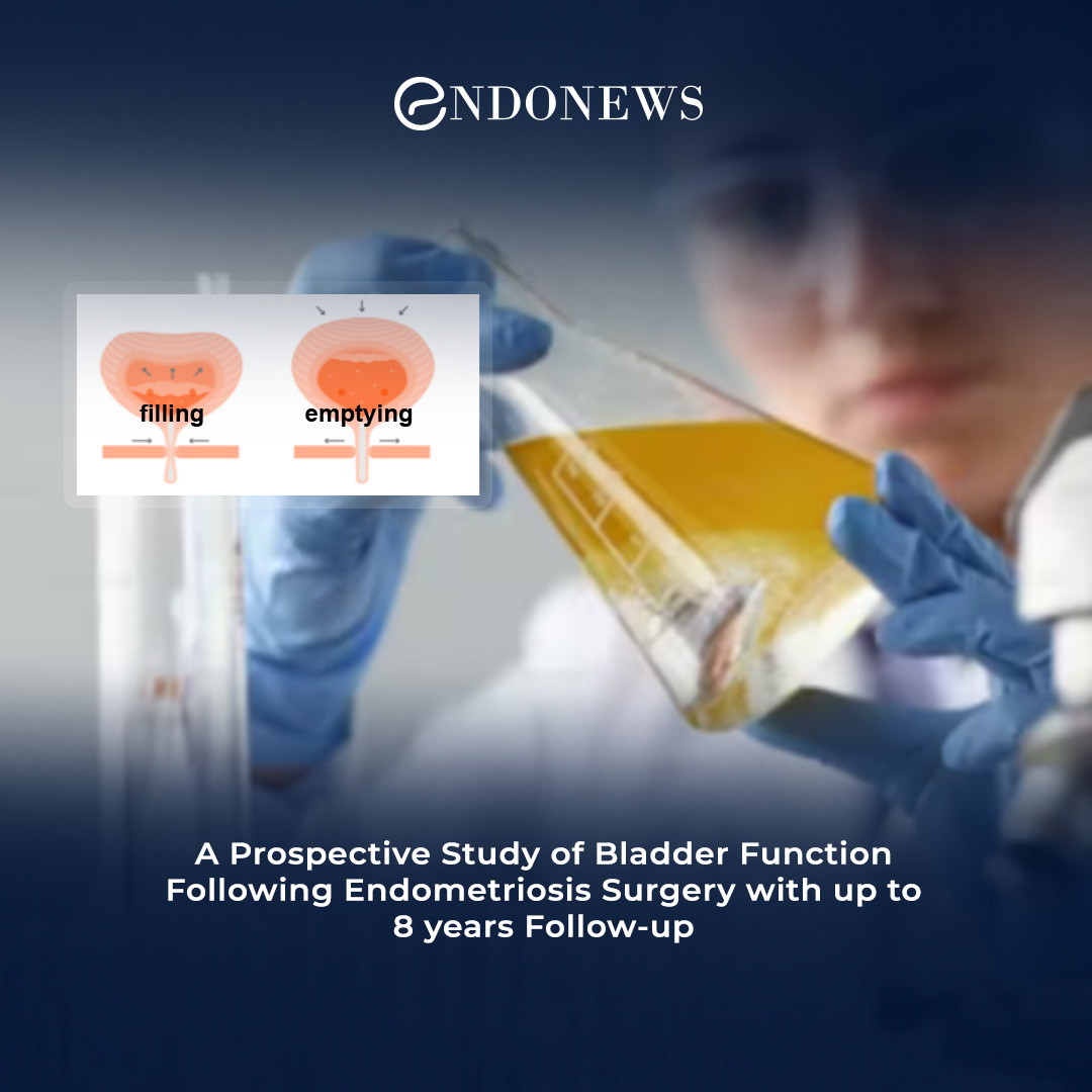 Bladder Function Alterations Following Endometriosis Surgery | EndoNews Bladder Function Alterations Following Endometriosis Surgery | EndoNews