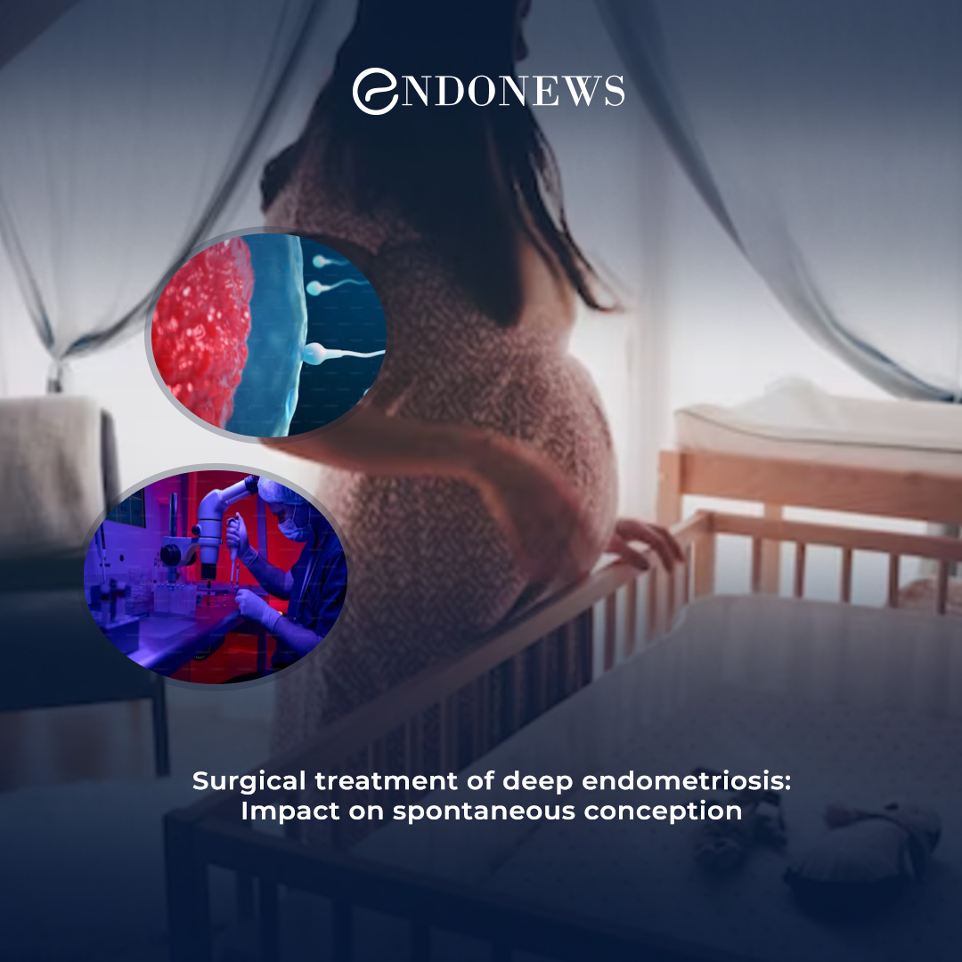 Spontaneous Conception After Deep Endometriosis Surgery | EndoNews