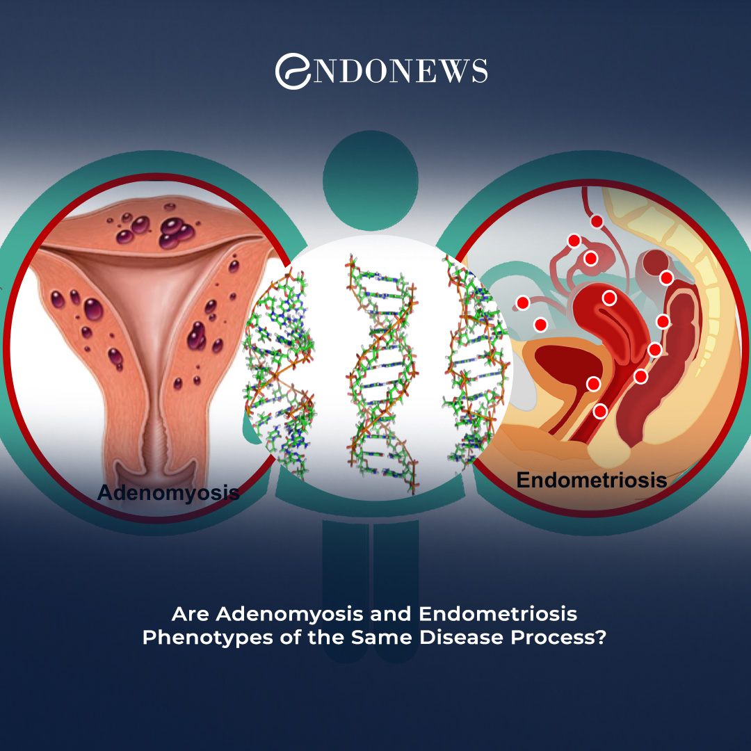 Endometriosis vs. adenomyosis : is there a common pathogenesis ? | EndoNews