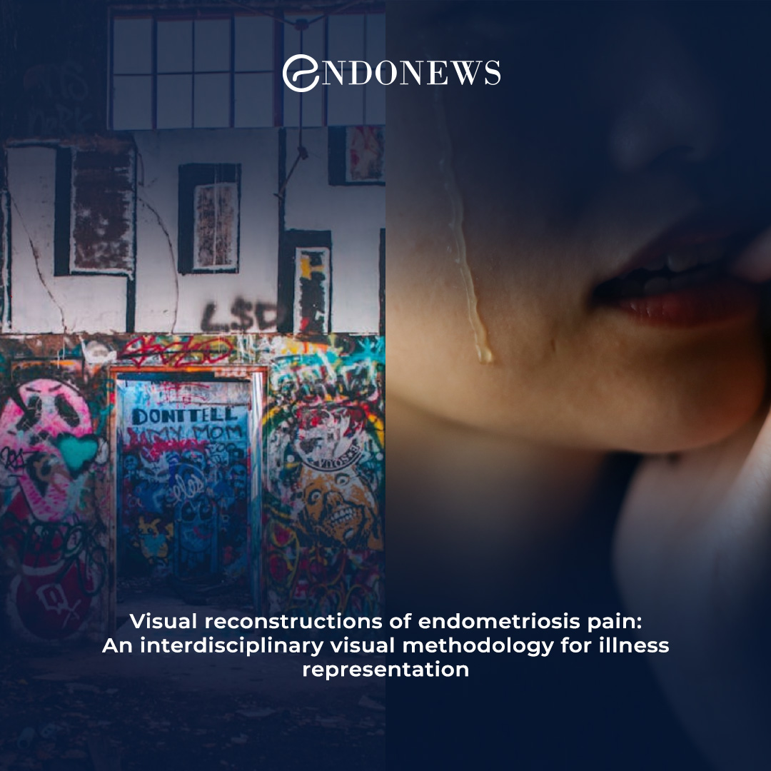 Visual representation of endometriosis pain | EndoNews