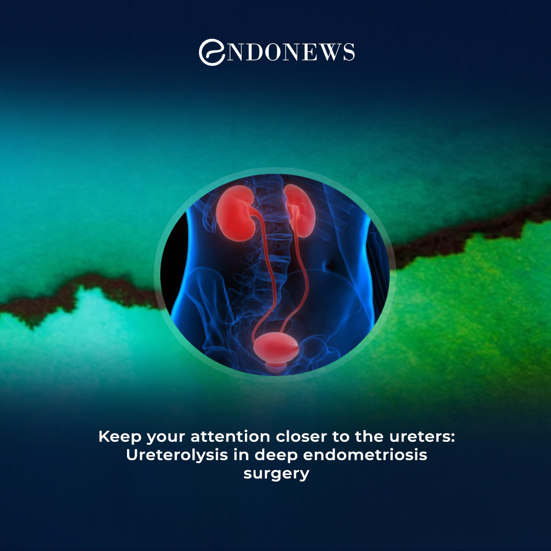 Key Aspects of Ureterolysis in deep endometriosis surgery | EndoNews