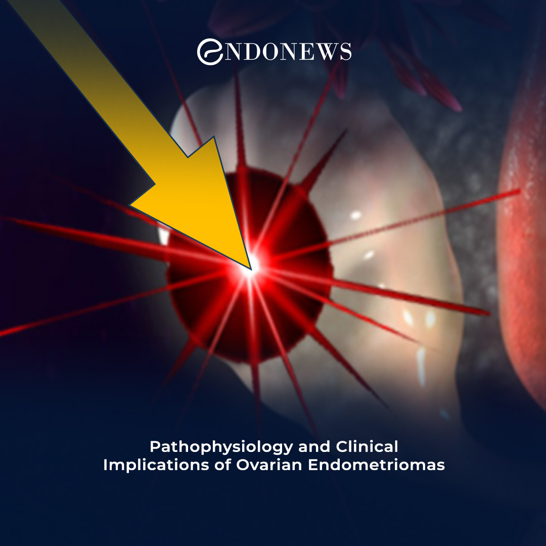 Ovarian endometriomas revisited | EndoNews