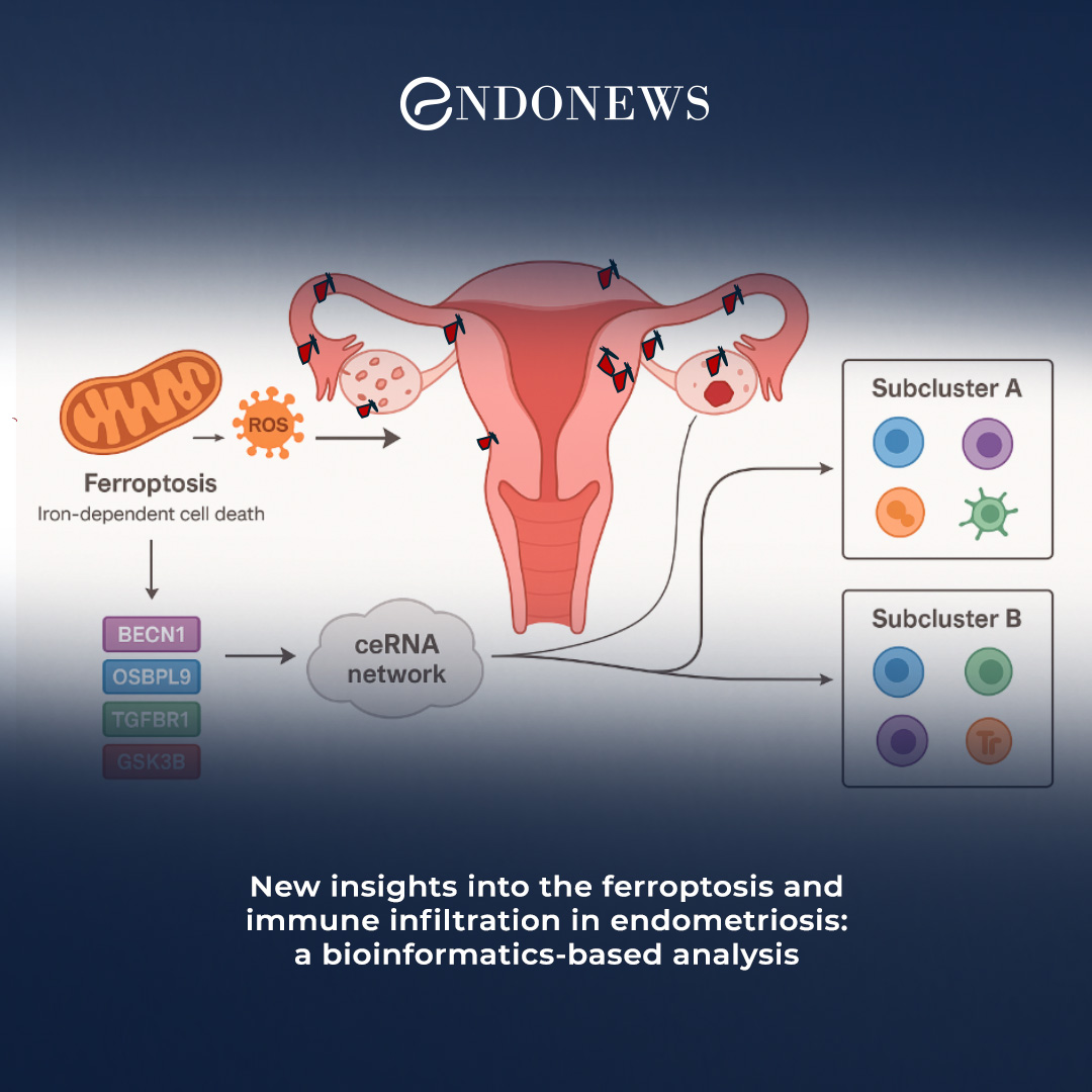 Ferroptosis: A New Mechanism Potentially Driving Endometriosis Progression | EndoNews