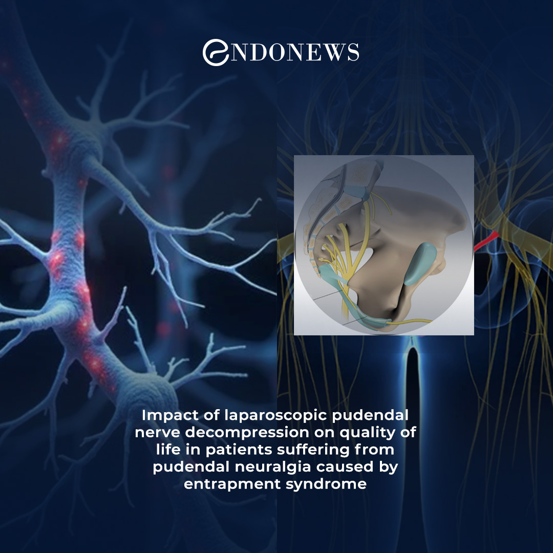 Laparoscopic Pudendal Neurolysis: A Solution for Entrapment-Related ...