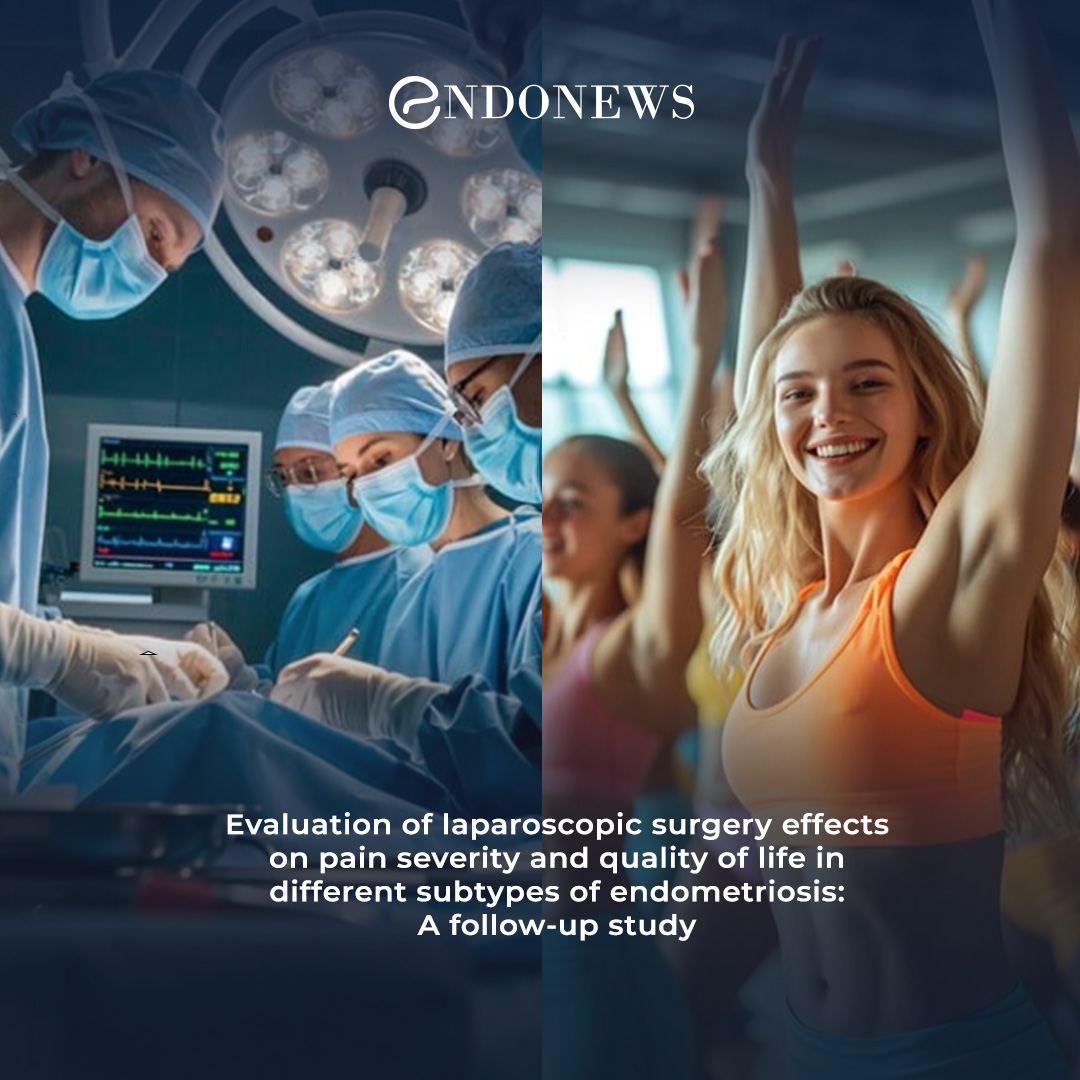 Laparoscopy Benefits Women With Endometriosis Across All Stages | EndoNews
